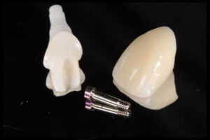 Screw Retained Crowns - RR Dental Lab