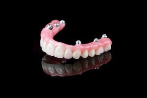 Screw Retained Zirconia Bridge - RR Dental Lab