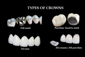 Types of Dental Crowns - RR Dental Lab
